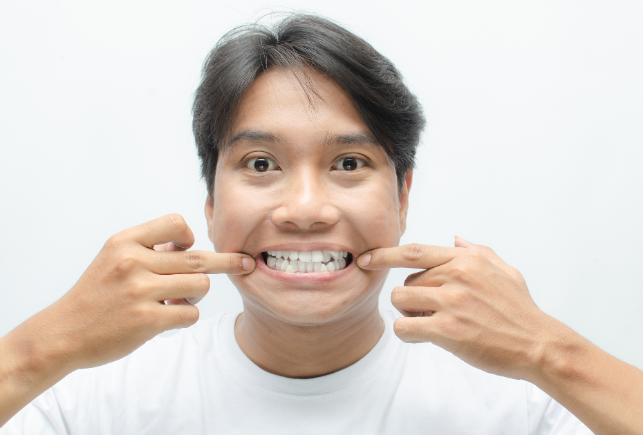 Overbite Treatment Journey: Clear Aligners Guide by Smileie